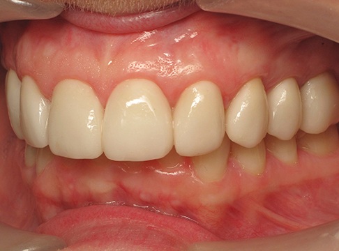 Veneers Gallery